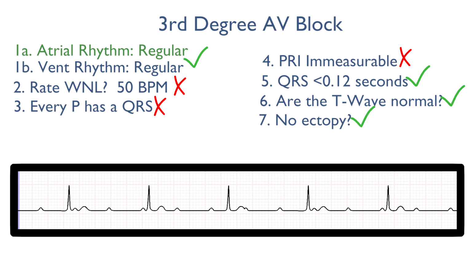 3rd Degree AV Block – Nursing Unraveled