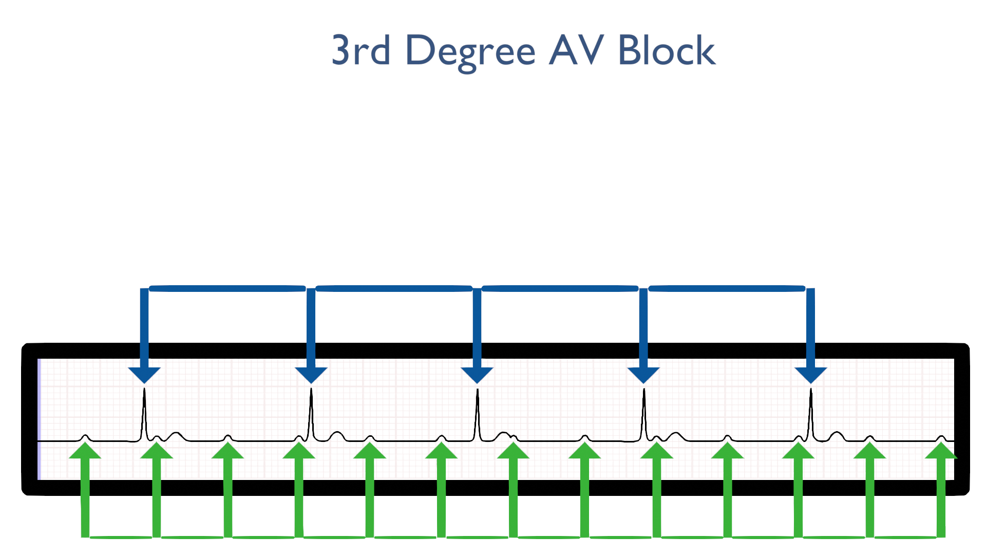 3rd Degree AV Block – Nursing Unraveled