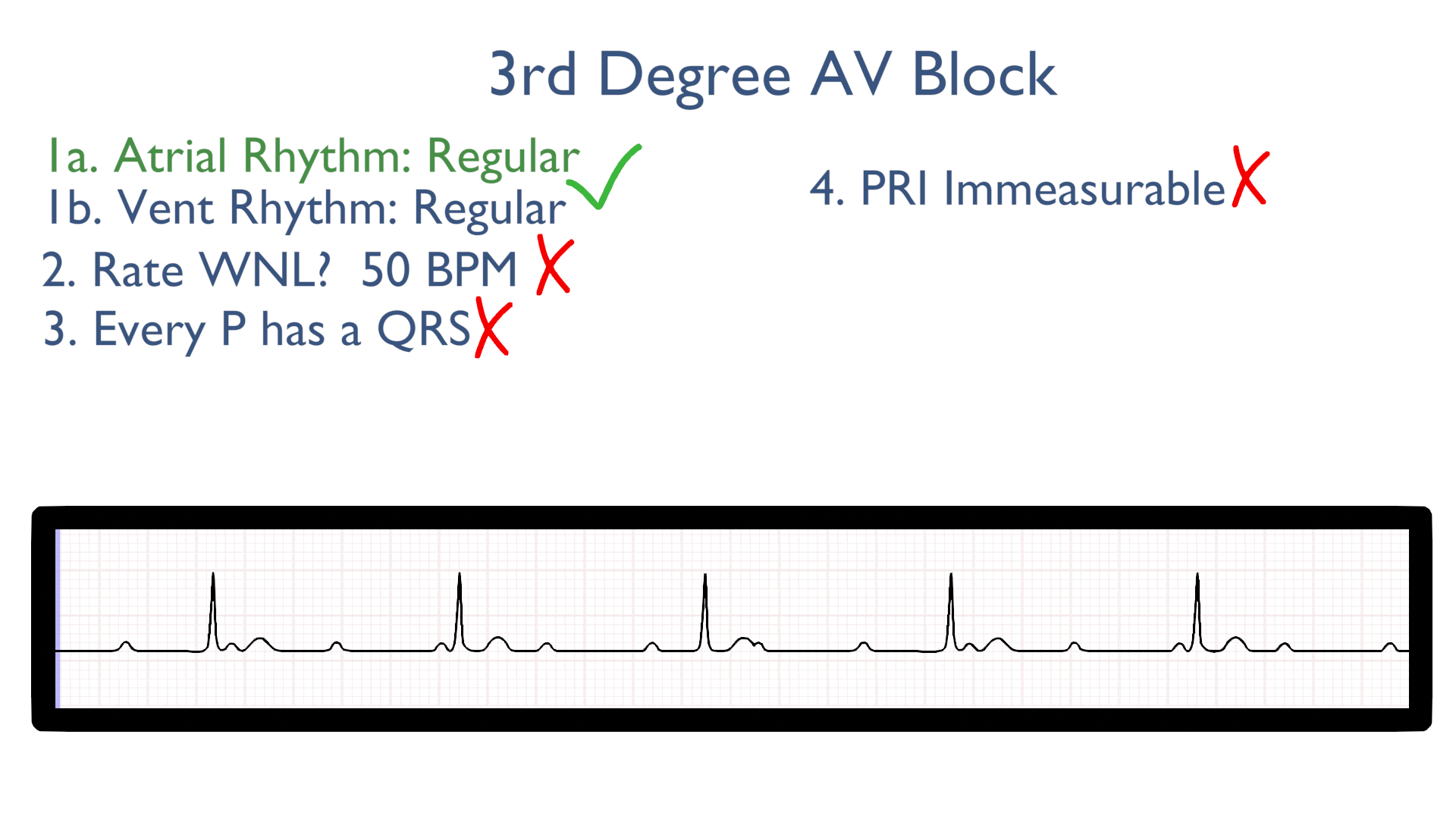 3rd Degree AV Block – Nursing Unraveled