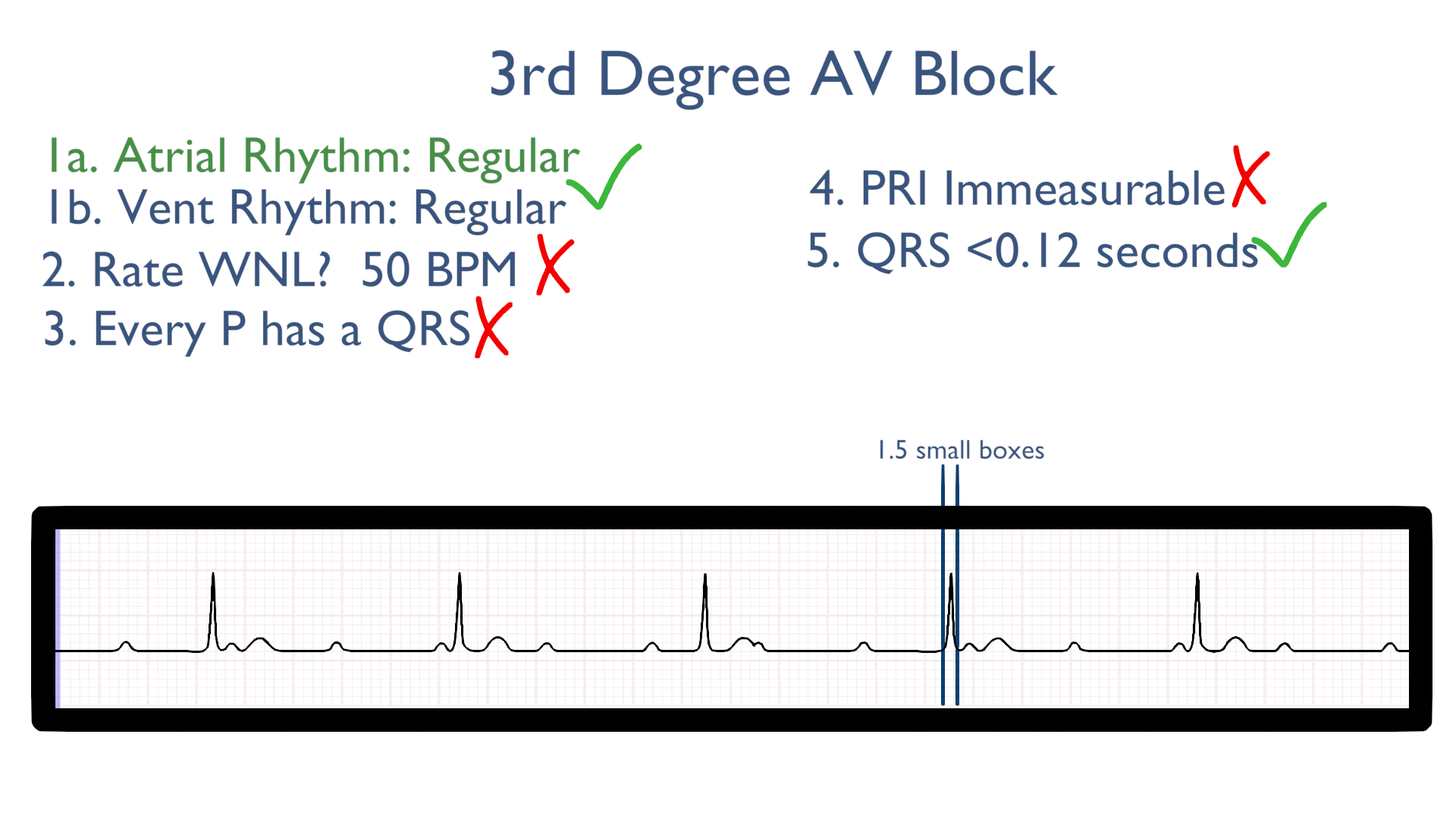 3rd Degree AV Block – Nursing Unraveled