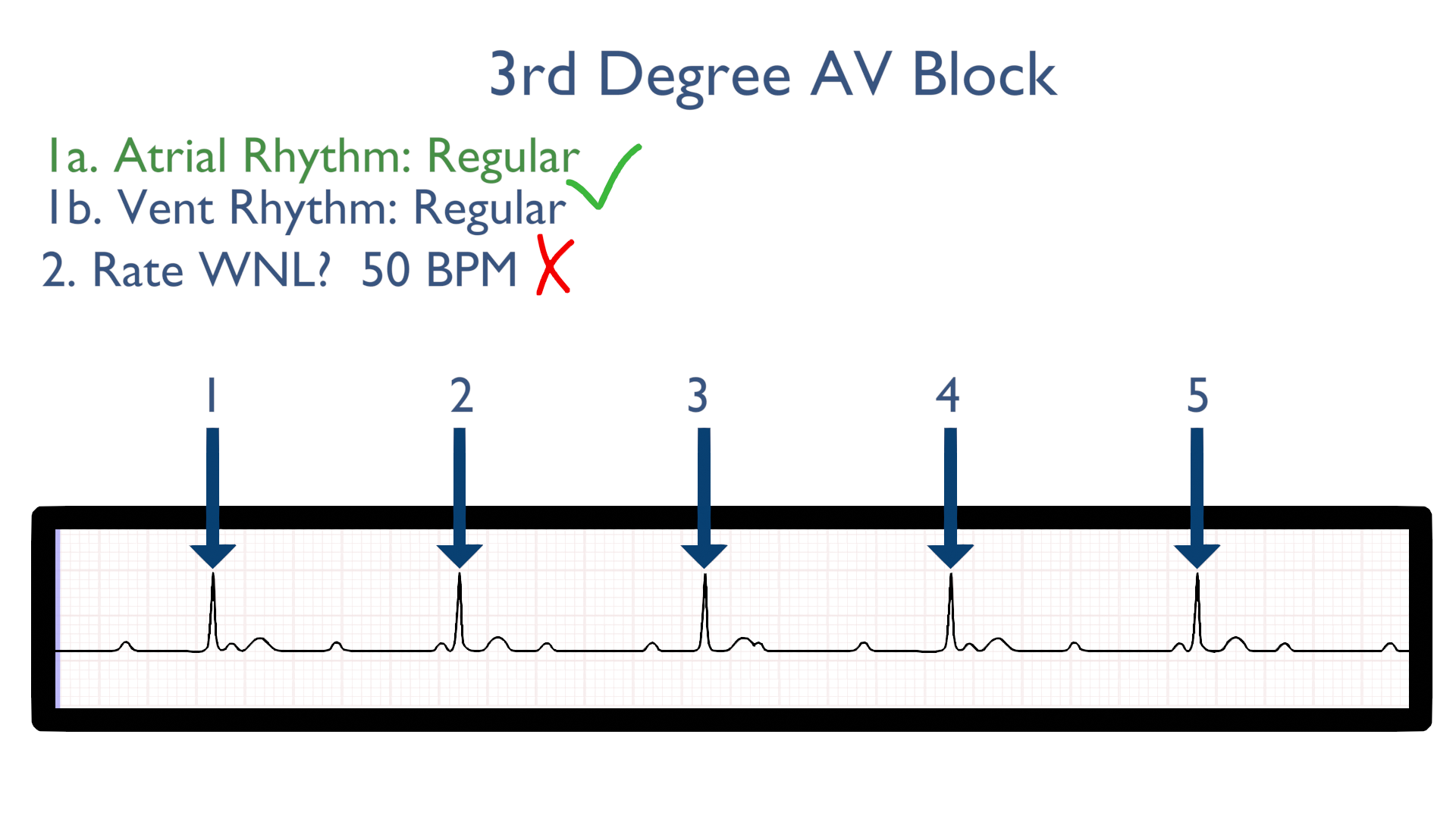 3rd Degree AV Block – Nursing Unraveled