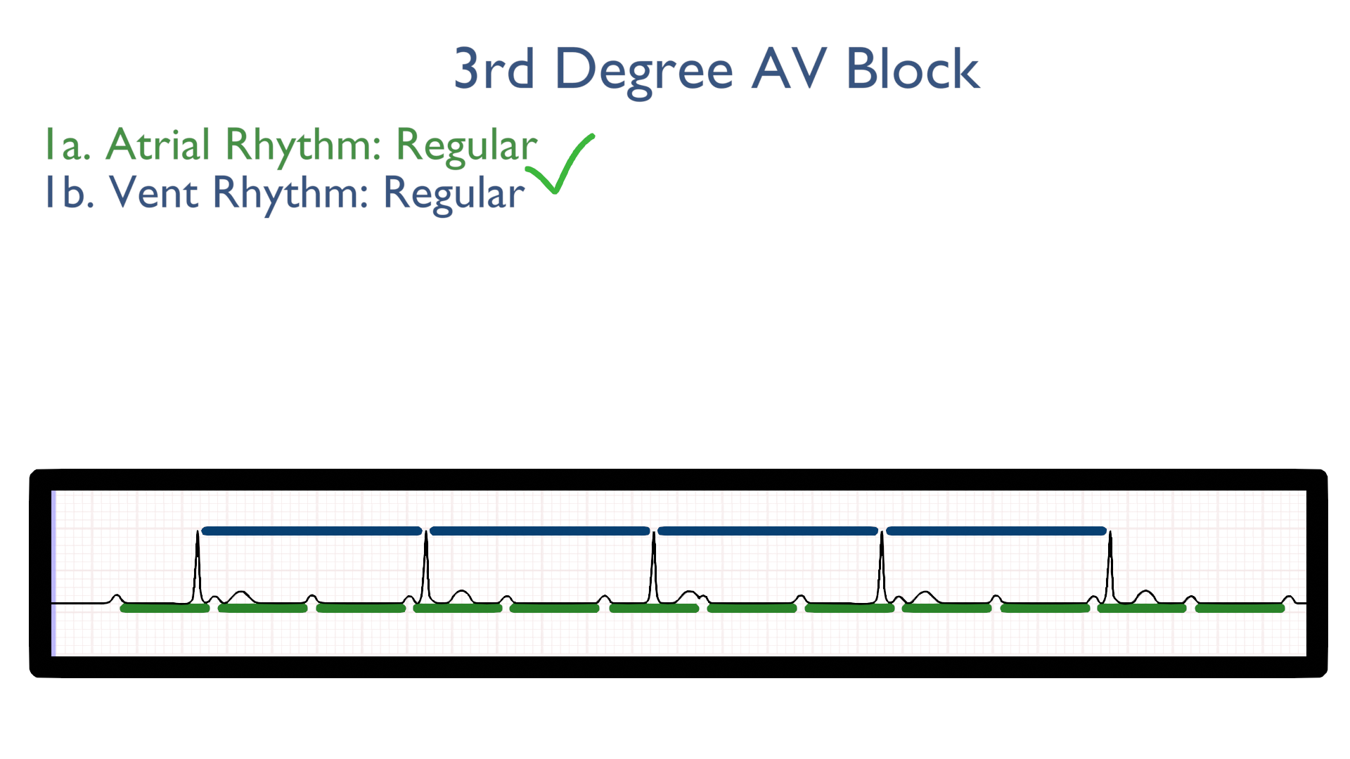 3rd Degree AV Block – Nursing Unraveled