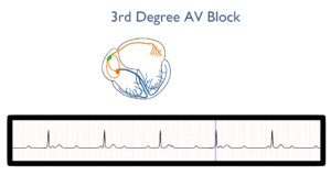 3rd Degree AV Block – Nursing Unraveled