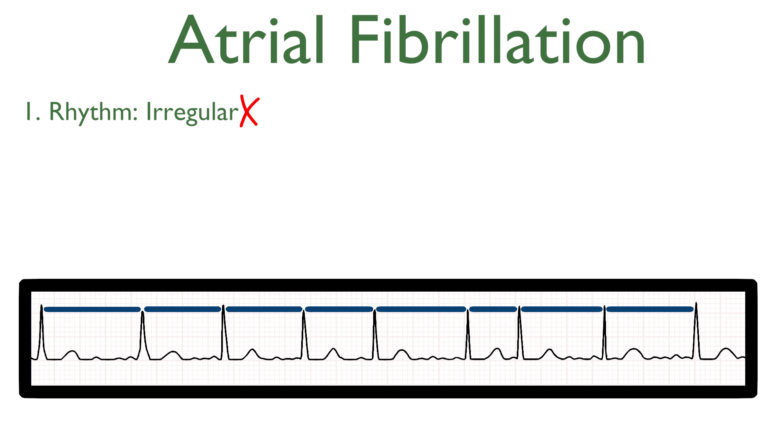 Atrial Fibrillation (AF) – Nursing Unraveled