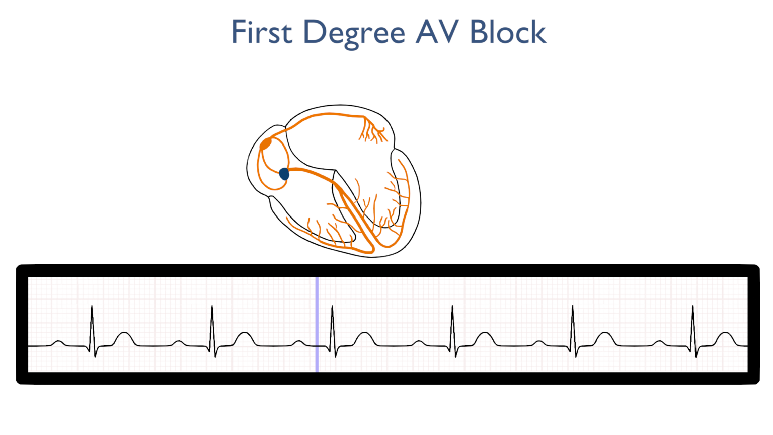 First Degree AV Block – Nursing Unraveled