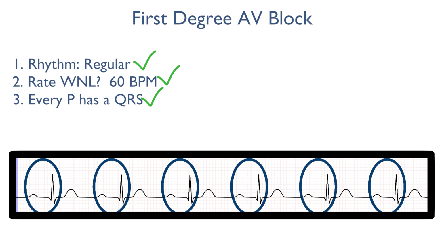 First Degree AV Block – Nursing Unraveled