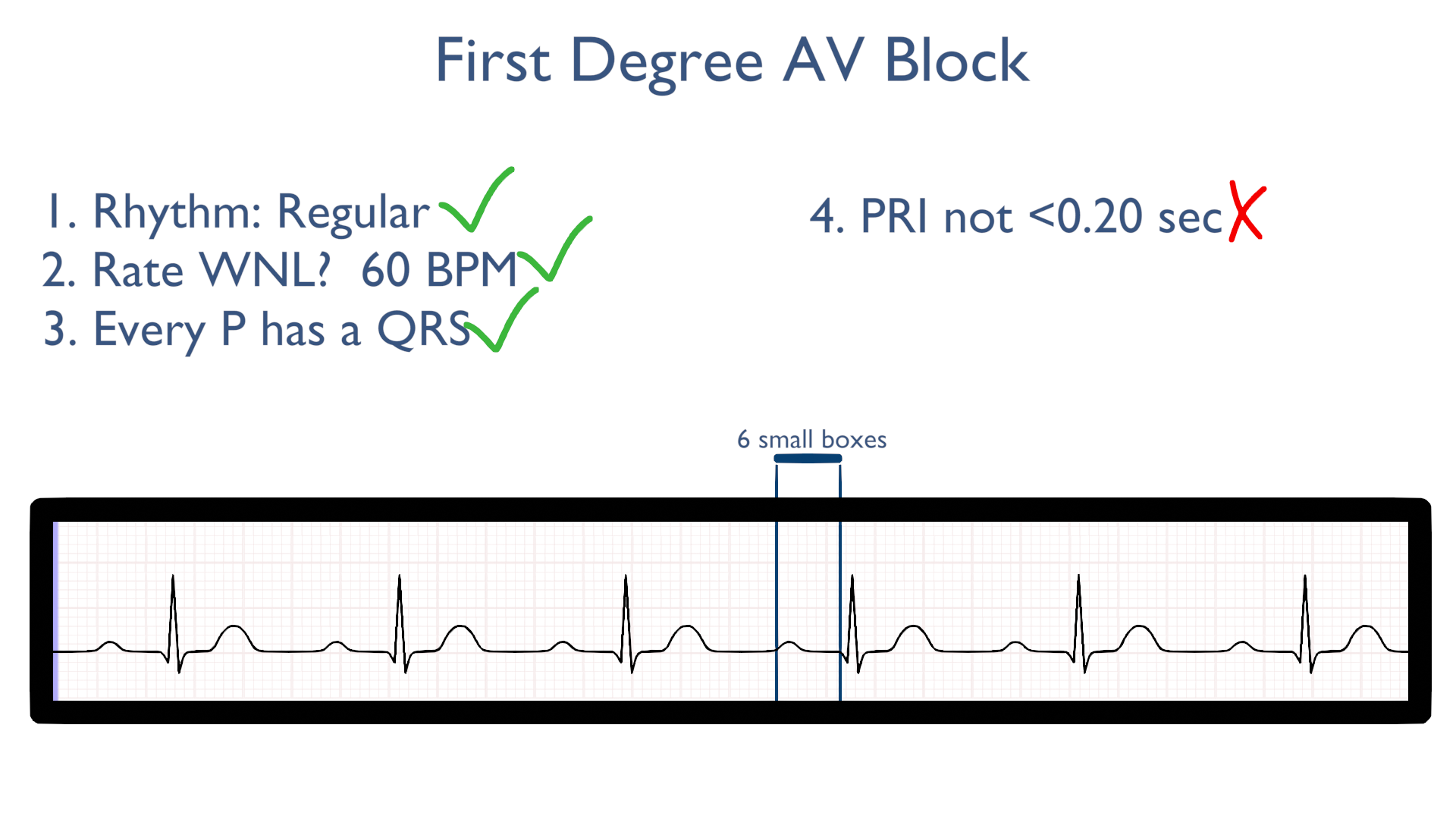 First Degree AV Block – Nursing Unraveled