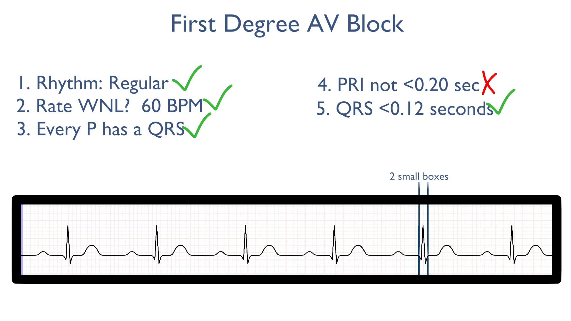 First Degree AV Block – Nursing Unraveled
