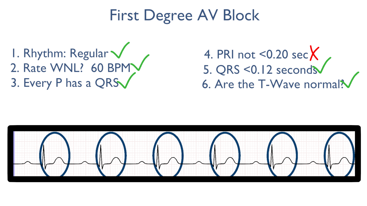 First Degree AV Block – Nursing Unraveled