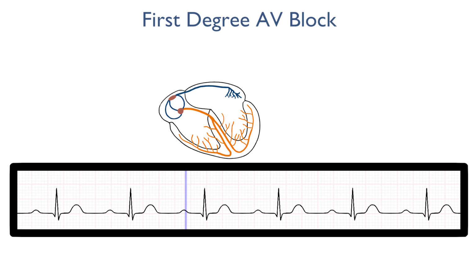 First Degree AV Block – Nursing Unraveled
