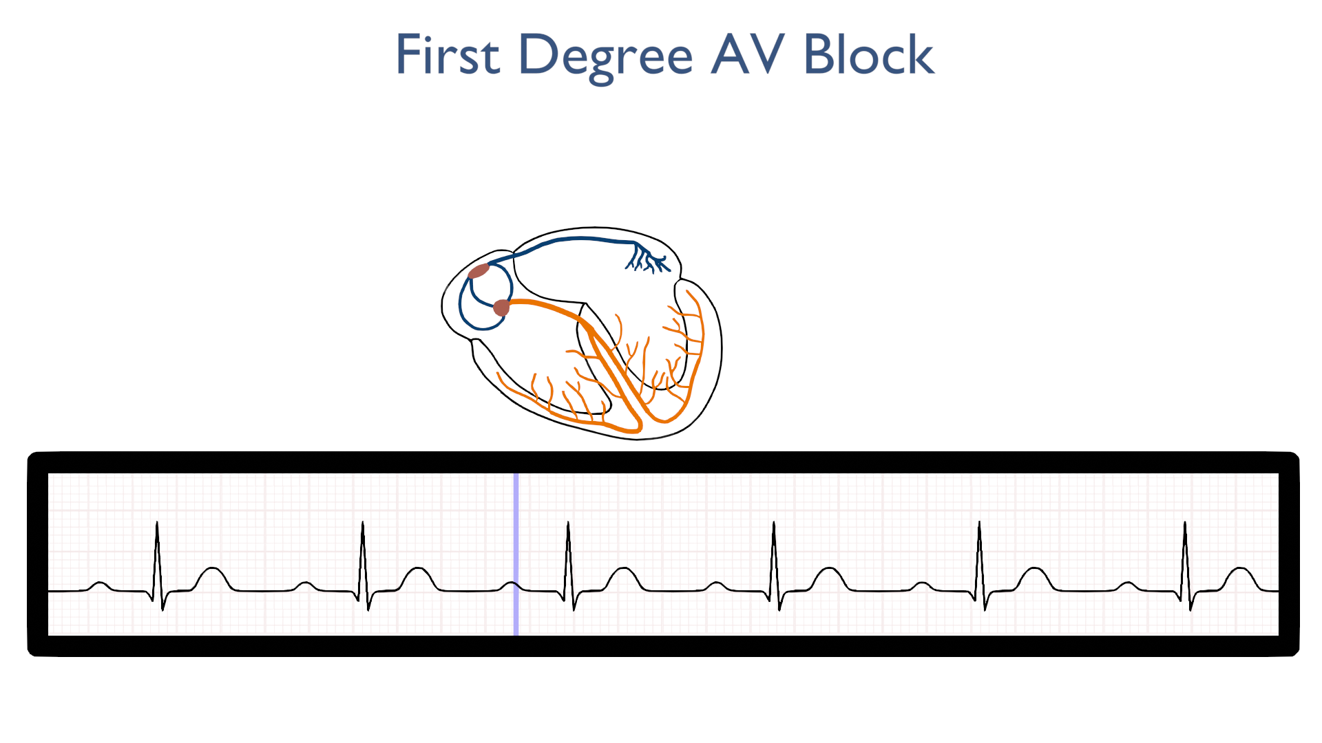 First Degree AV Block – Nursing Unraveled