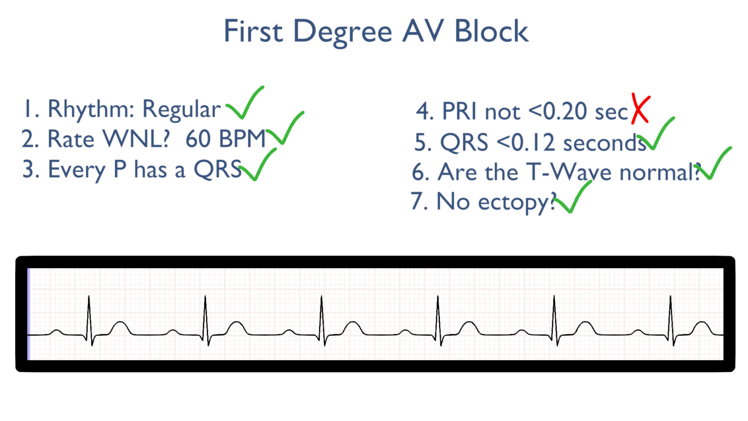 First Degree AV Block – Nursing Unraveled