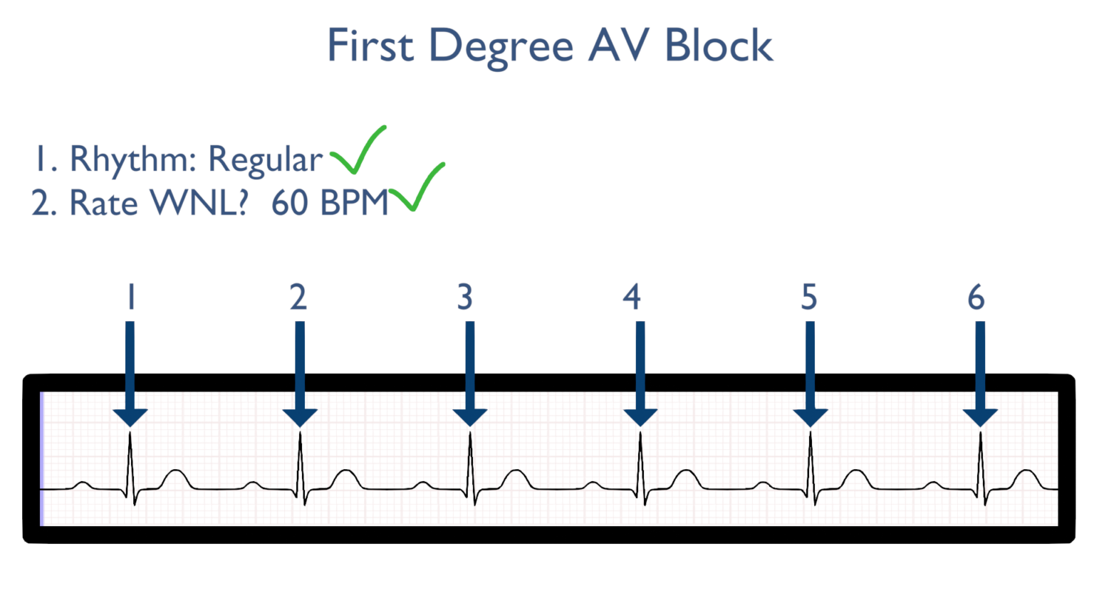 First Degree AV Block – Nursing Unraveled