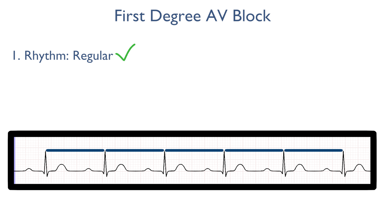 First Degree AV Block – Nursing Unraveled