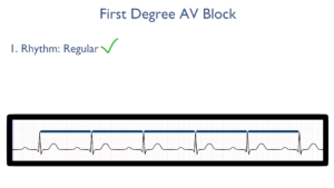 First Degree AV Block – Nursing Unraveled