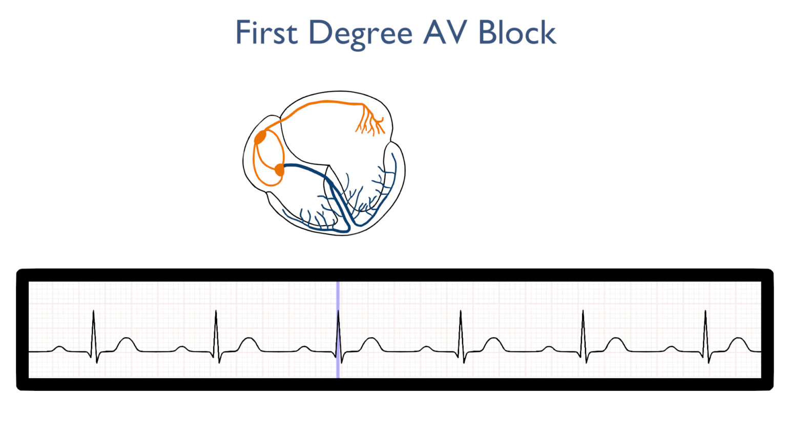 First Degree AV Block – Nursing Unraveled