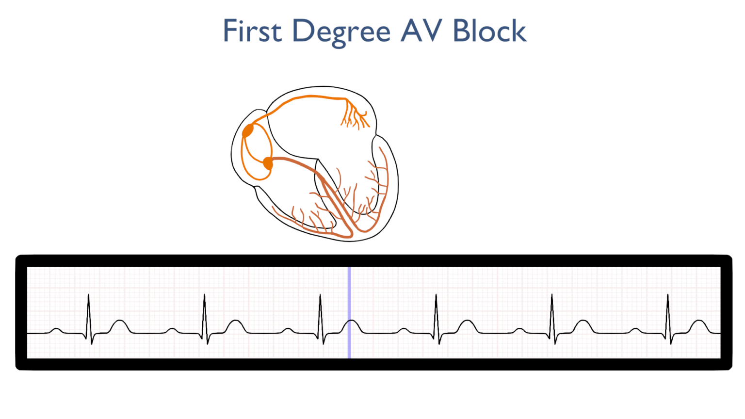 First Degree AV Block – Nursing Unraveled
