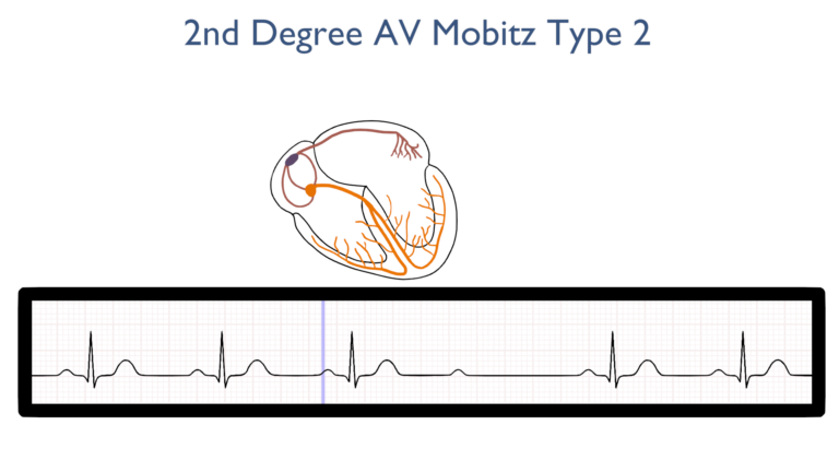 Type 2 AV Block Mobitz 2 – Nursing Unraveled