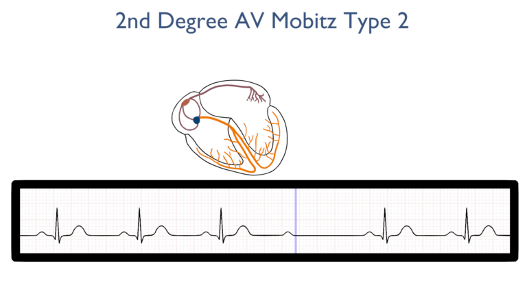 Type 2 AV Block Mobitz 2 – Nursing Unraveled
