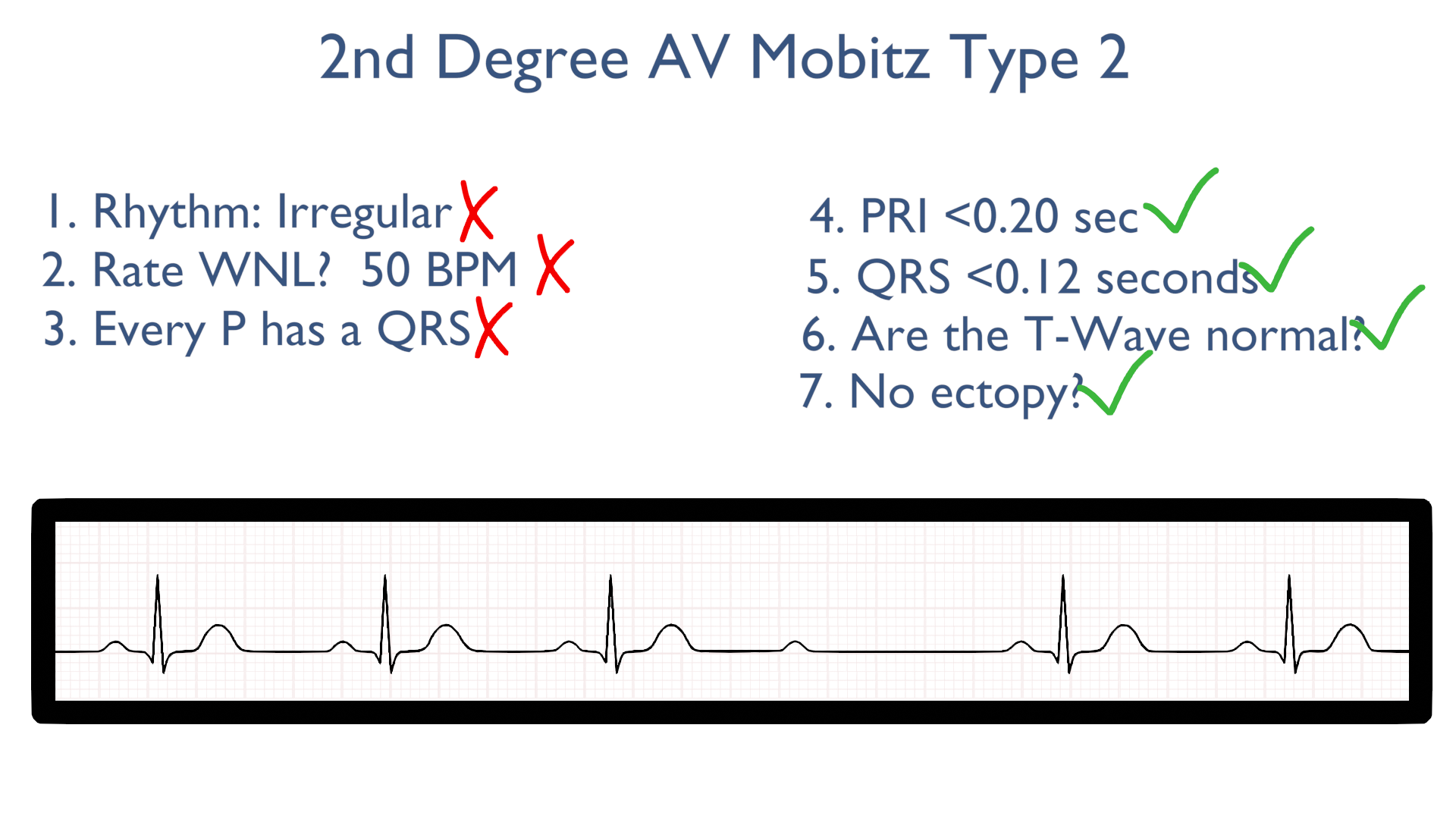 Type 2 AV Block Mobitz 2 – Nursing Unraveled