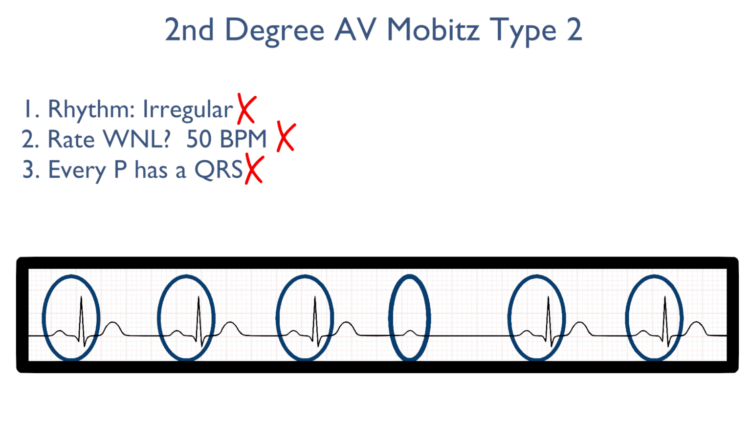 Type 2 AV Block Mobitz 2 – Nursing Unraveled