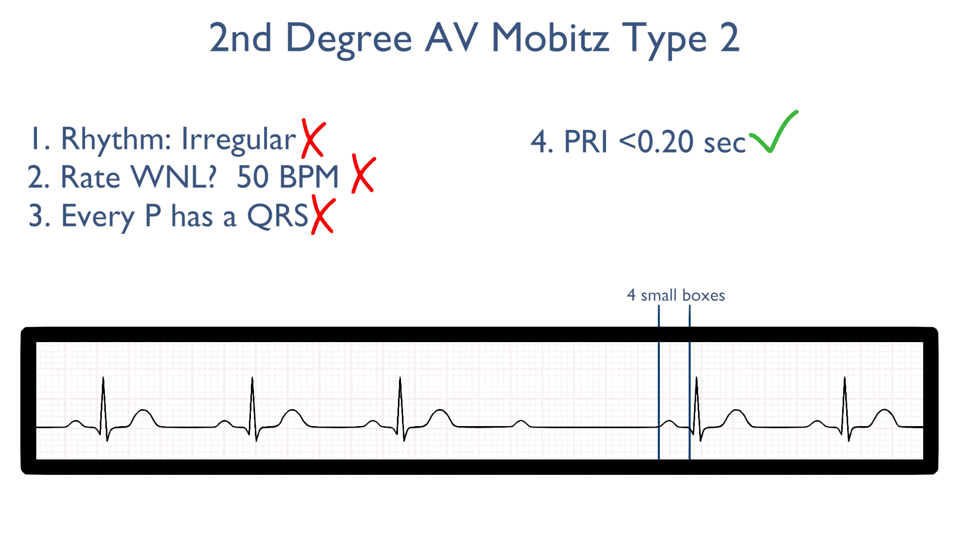 Type 2 AV Block Mobitz 2 – Nursing Unraveled