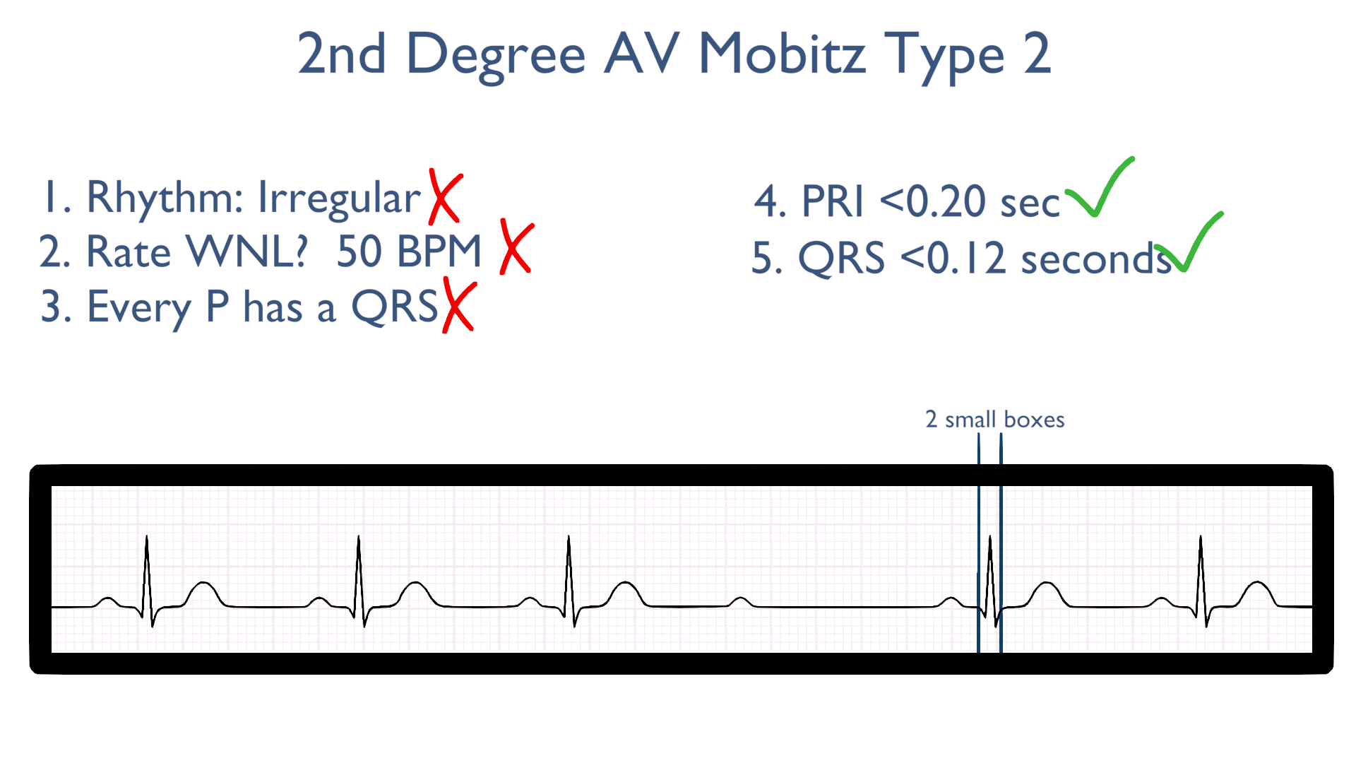Type 2 AV Block Mobitz 2 – Nursing Unraveled