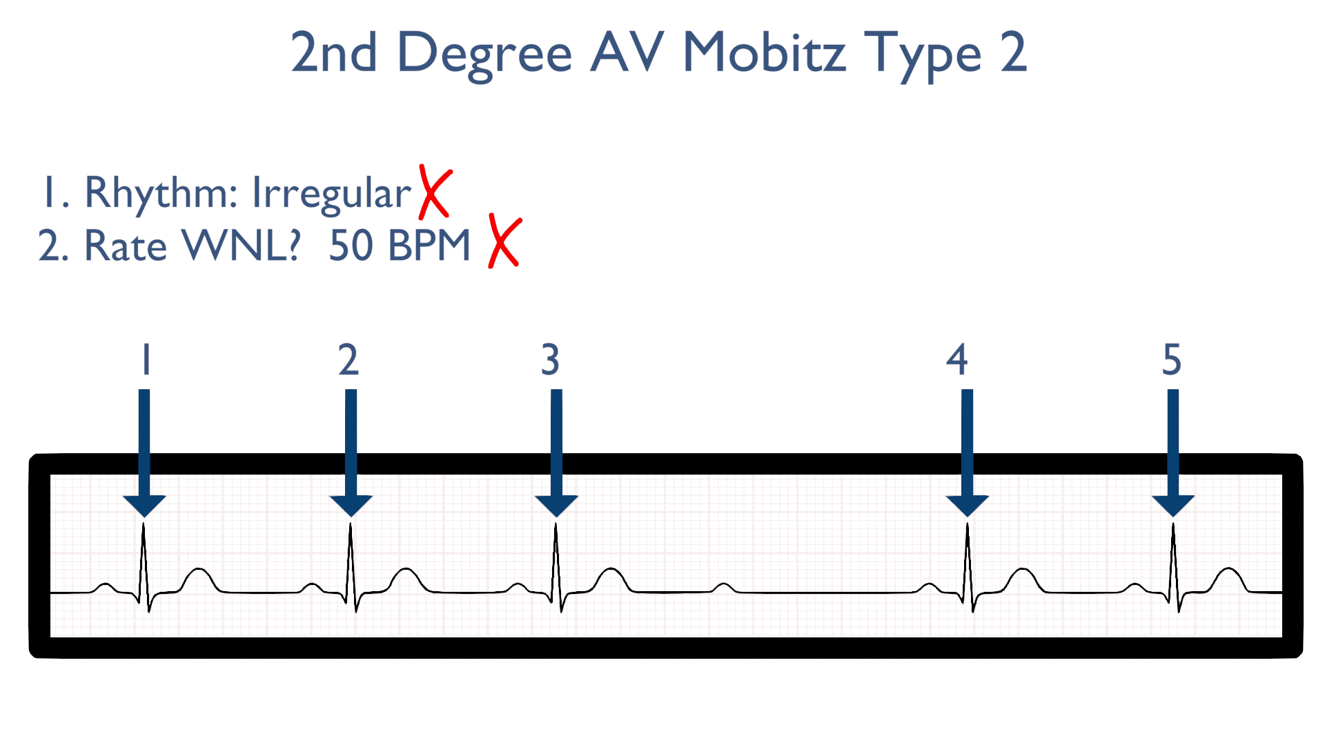 Type 2 AV Block Mobitz 2 – Nursing Unraveled