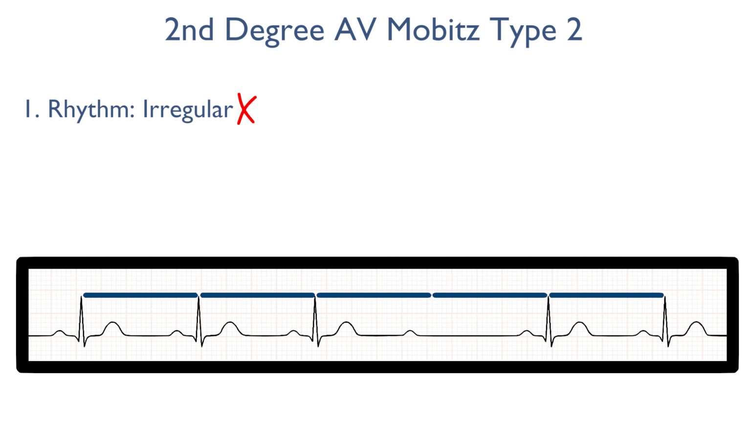 Type 2 AV Block Mobitz 2 – Nursing Unraveled