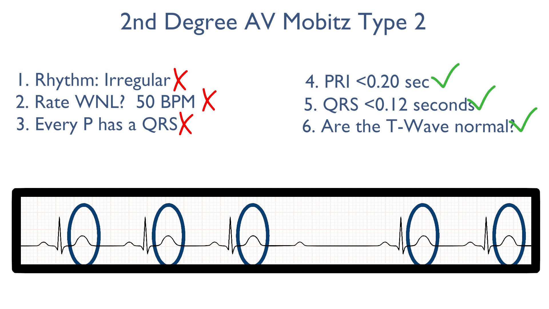 Type 2 AV Block Mobitz 2 – Nursing Unraveled