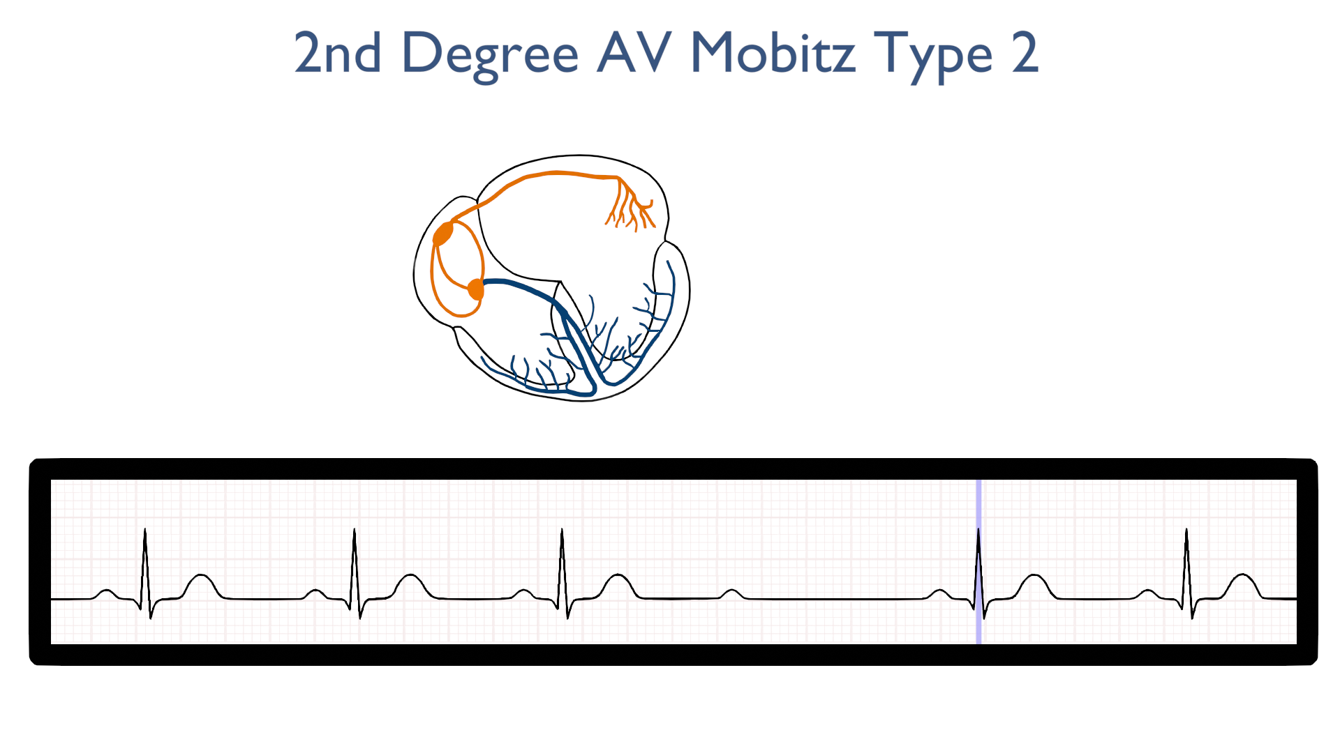 Type 2 AV Block Mobitz 2 – Nursing Unraveled