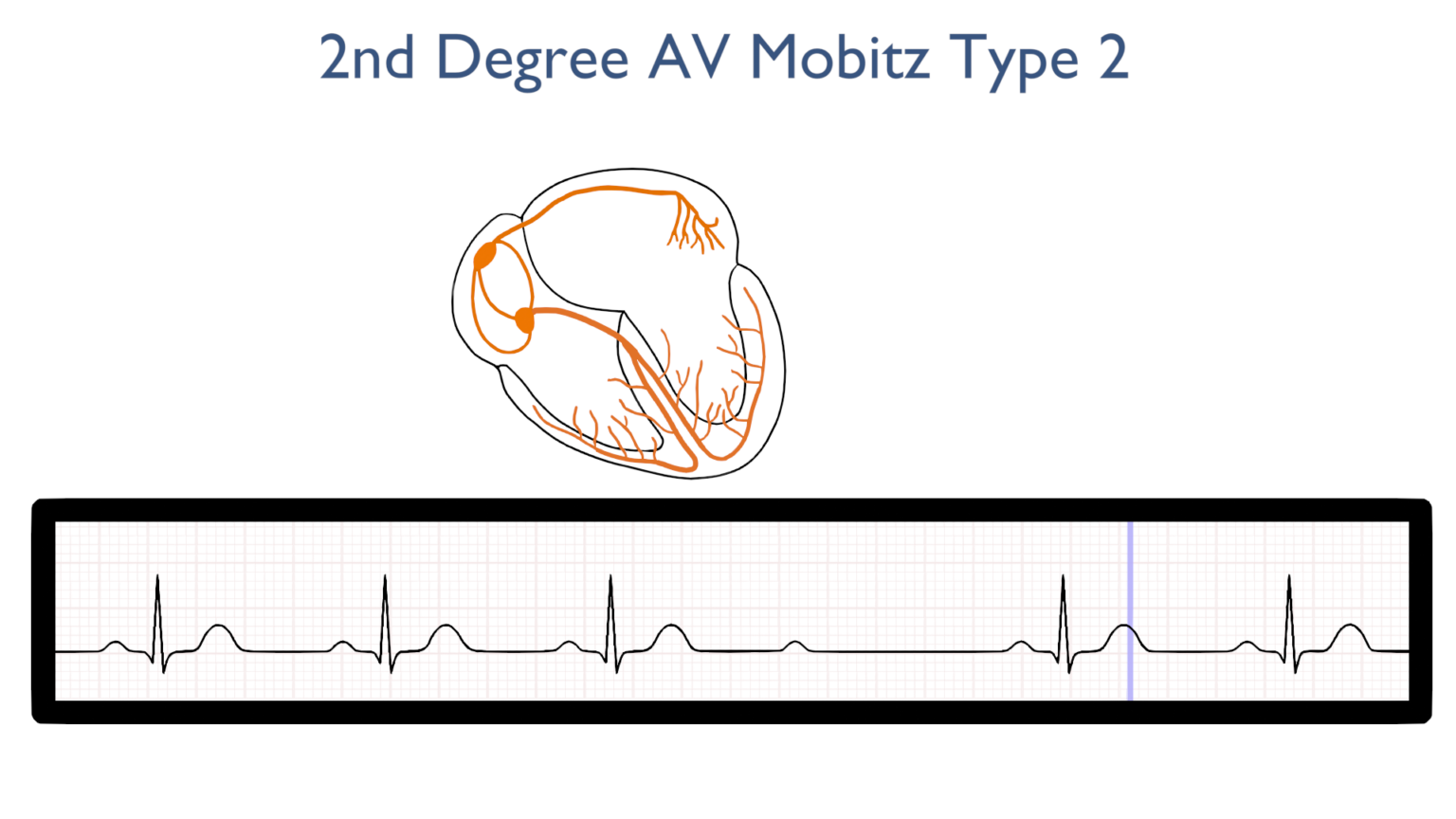 Type 2 AV Block Mobitz 2 – Nursing Unraveled